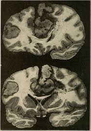 Understanding Alexia: Causes, Symptoms, and Treatment – Ideas